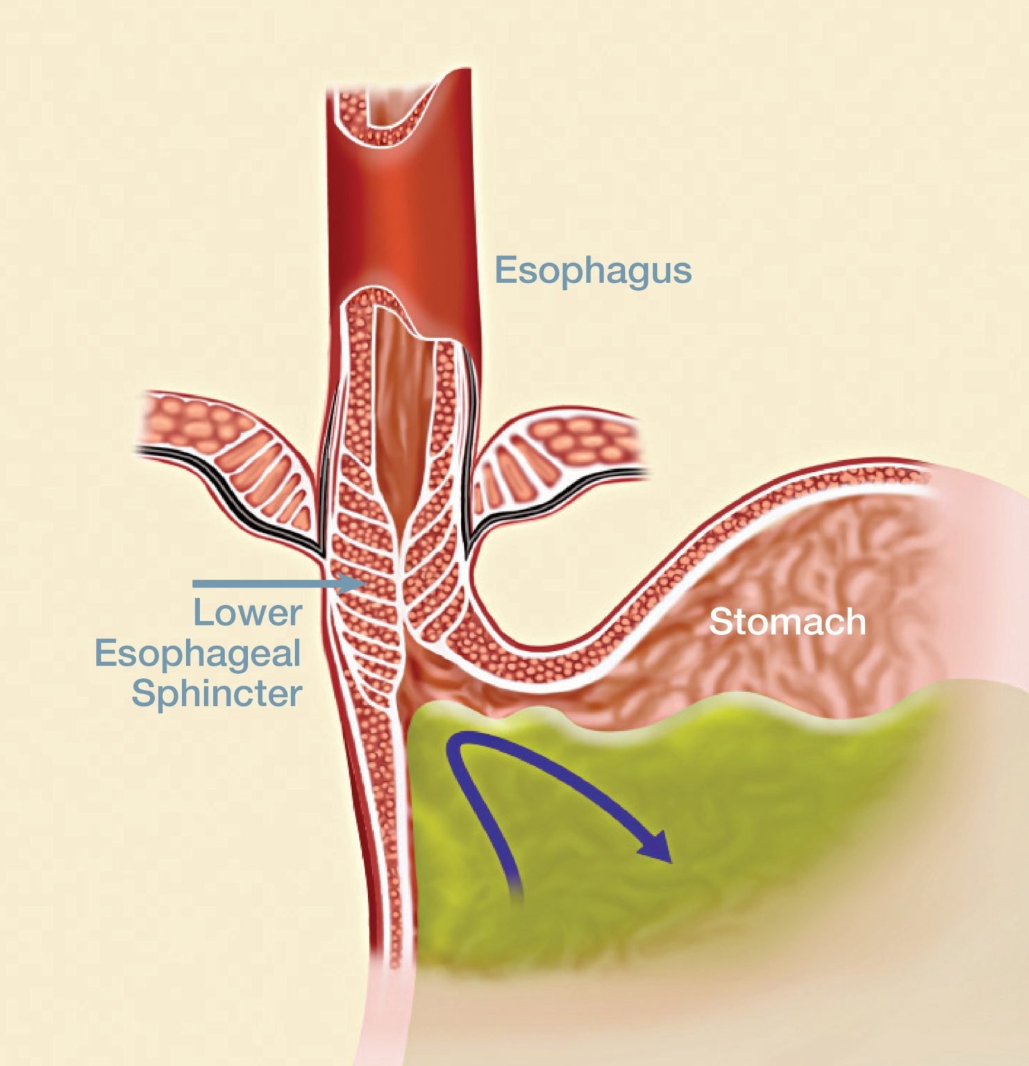 LINX Procedure - Virginia Heartburn and Hernia Institute